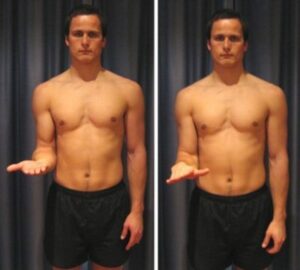 Bicep Strain - Strained Bicep Muscle - PhysioAdvisor