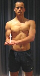 Bicep Strain - Strained Bicep Muscle - PhysioAdvisor