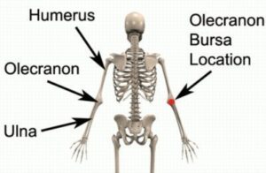 Olecranon Bursitis - Elbow Bursitis – PhysioAdvisor