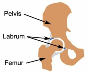 Hip Labral Tear – Causes, Symptoms, Treatment, Exercises